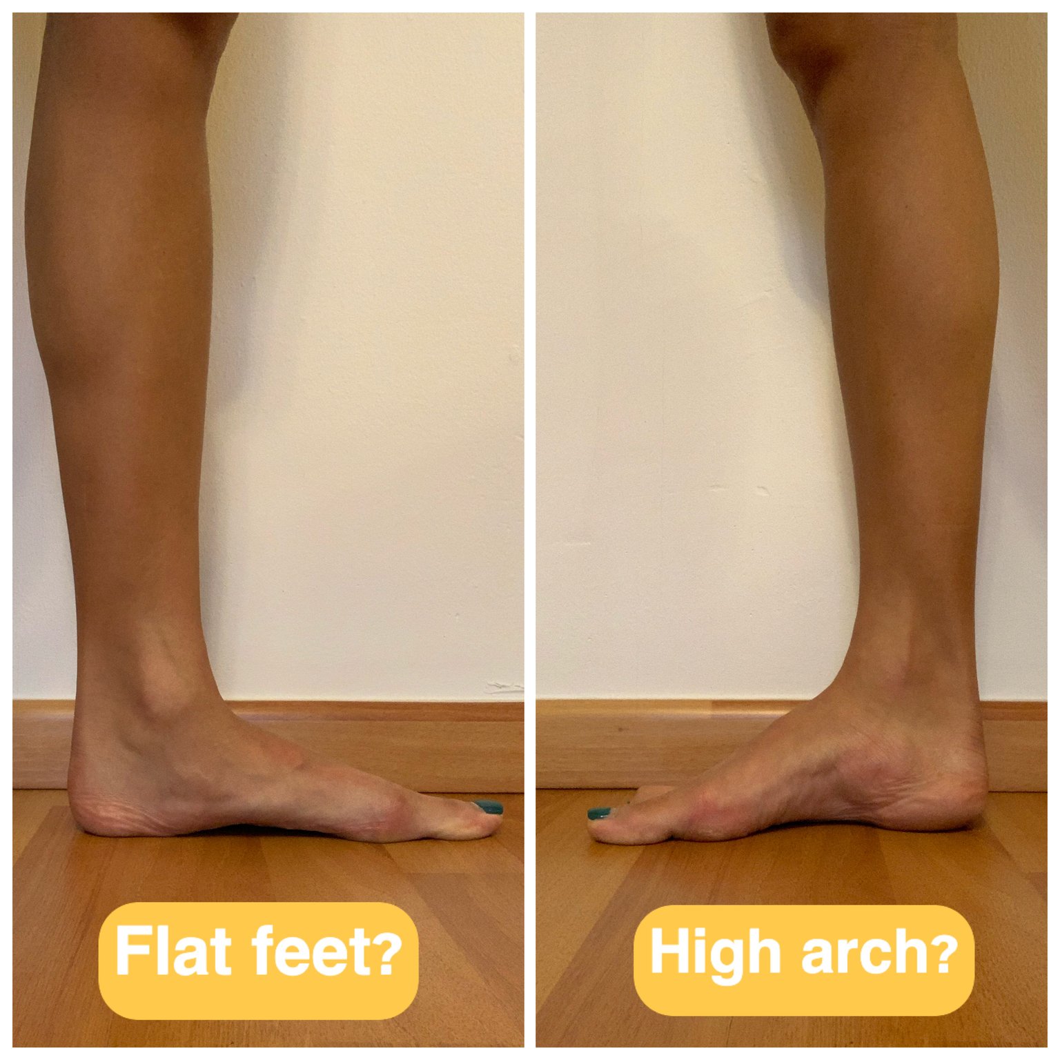 Flat Feet and High Arches: What do they mean?