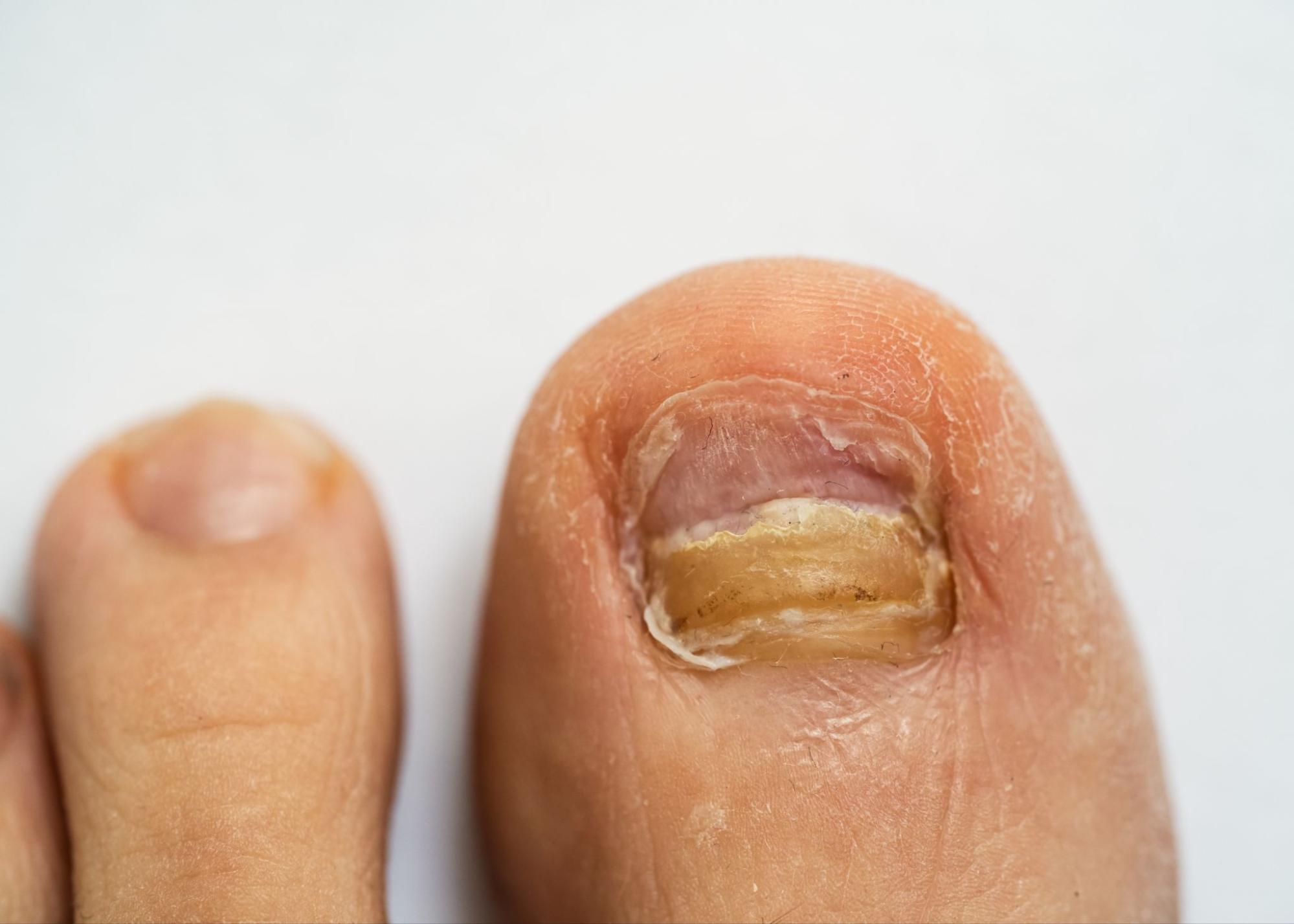 Is Your Yellow/Brown Toenail a Fungal Nail Infection?